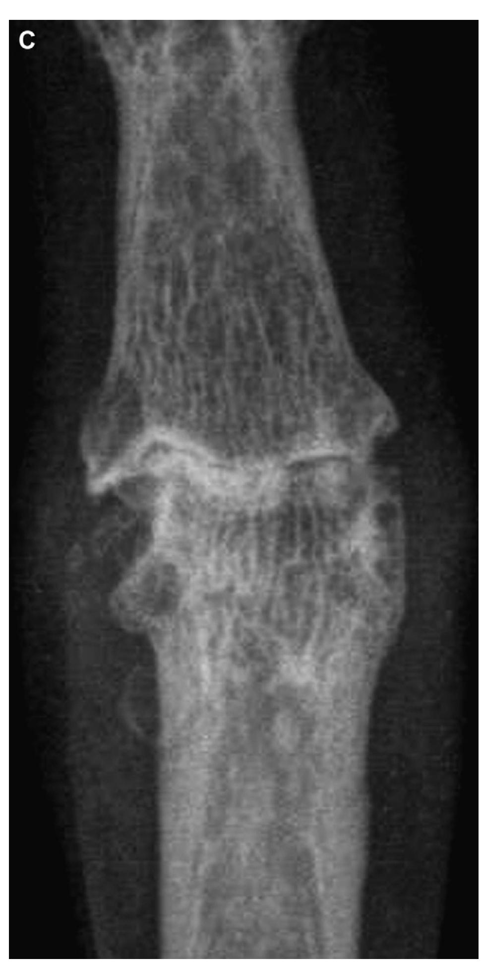 Hand pip: (a) erosion, (b) subchondral cyst, and (c)