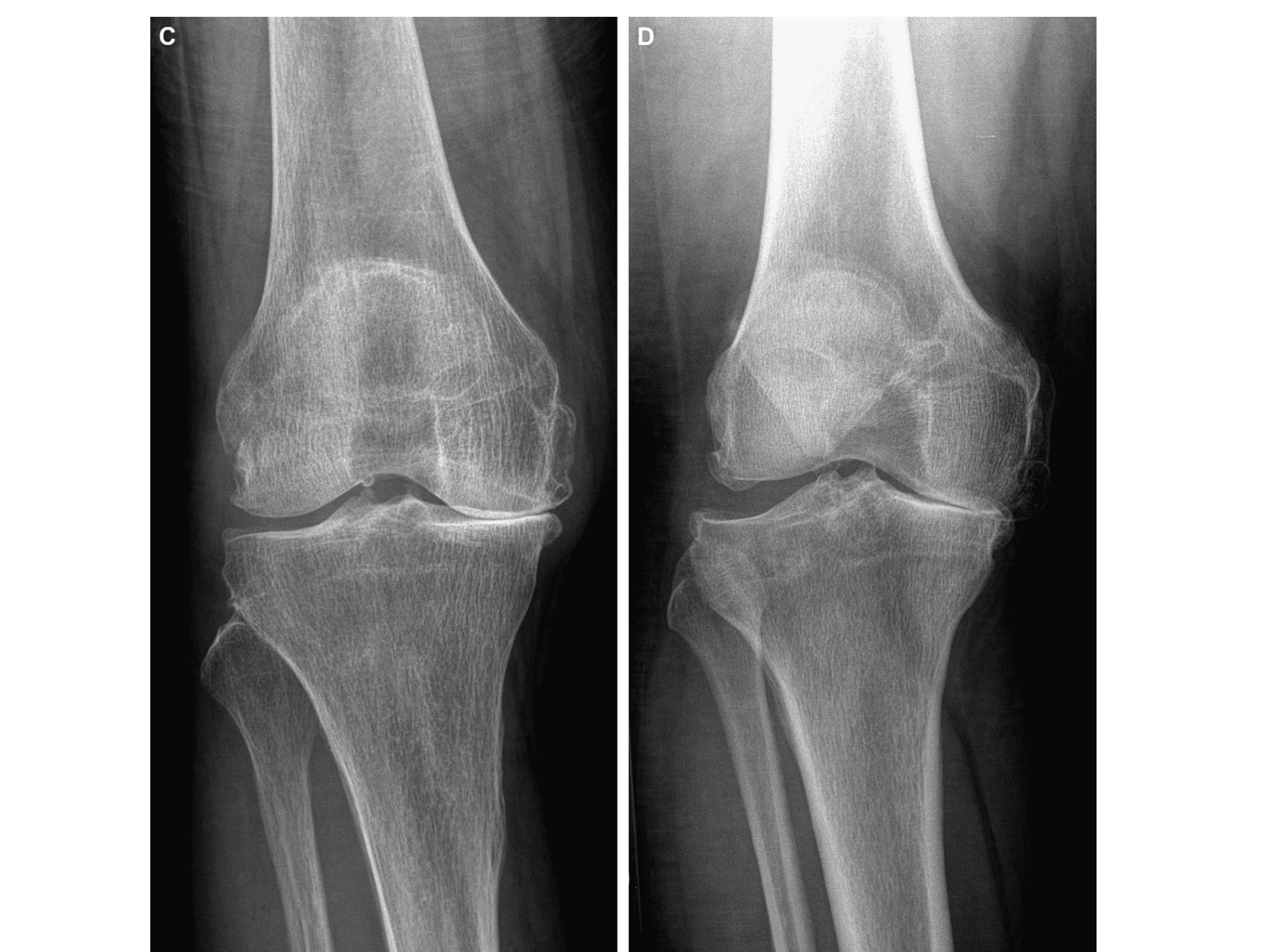 Knee: (a) grade 0 normal, (b) grade 1 medial tibial