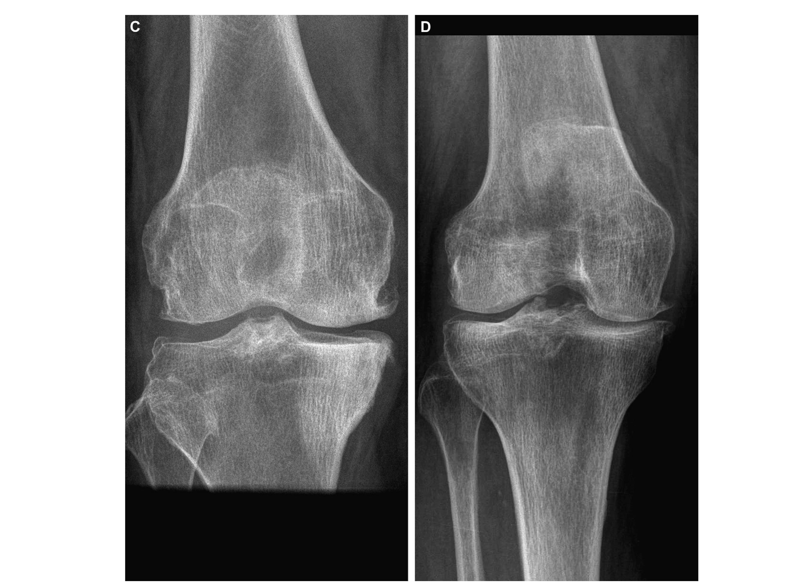 Knee: (a) normal, (b) medial tibial attrition, (c) medial