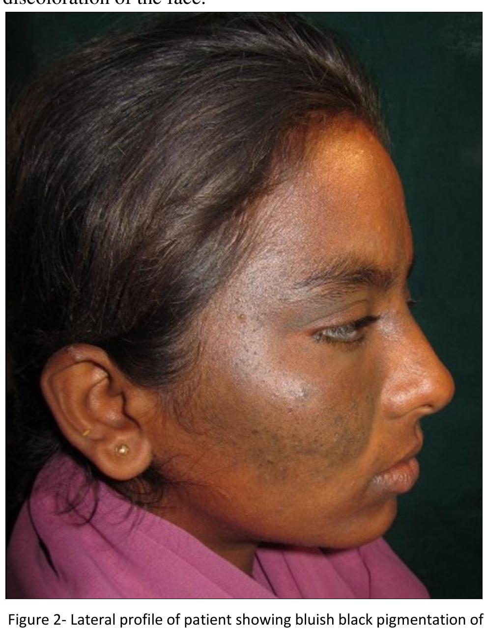 Figure 3 - A Nevus of OTA with Intraoral Involvement: A Rare