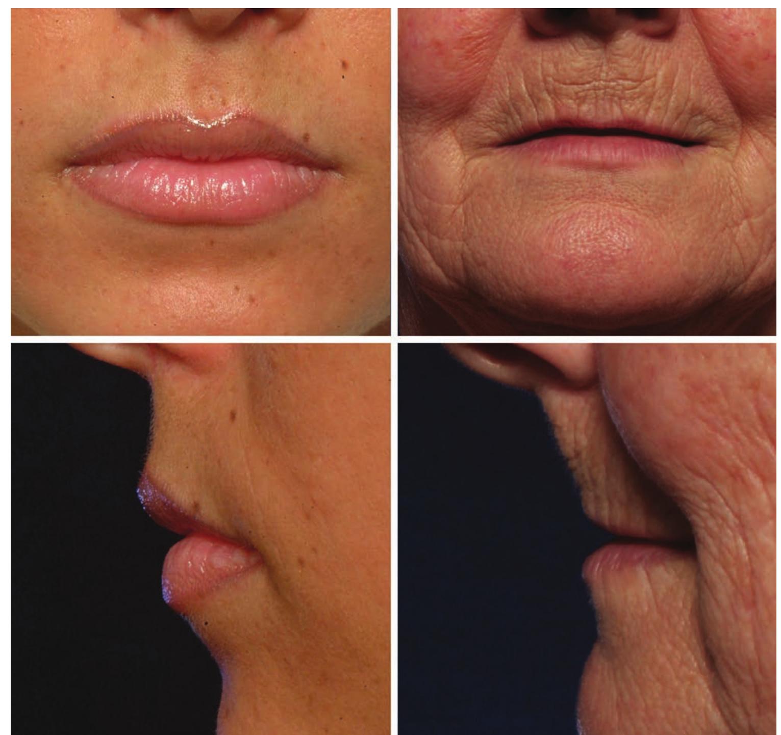 Clinical comparison of the perioral area of a 20-year-old