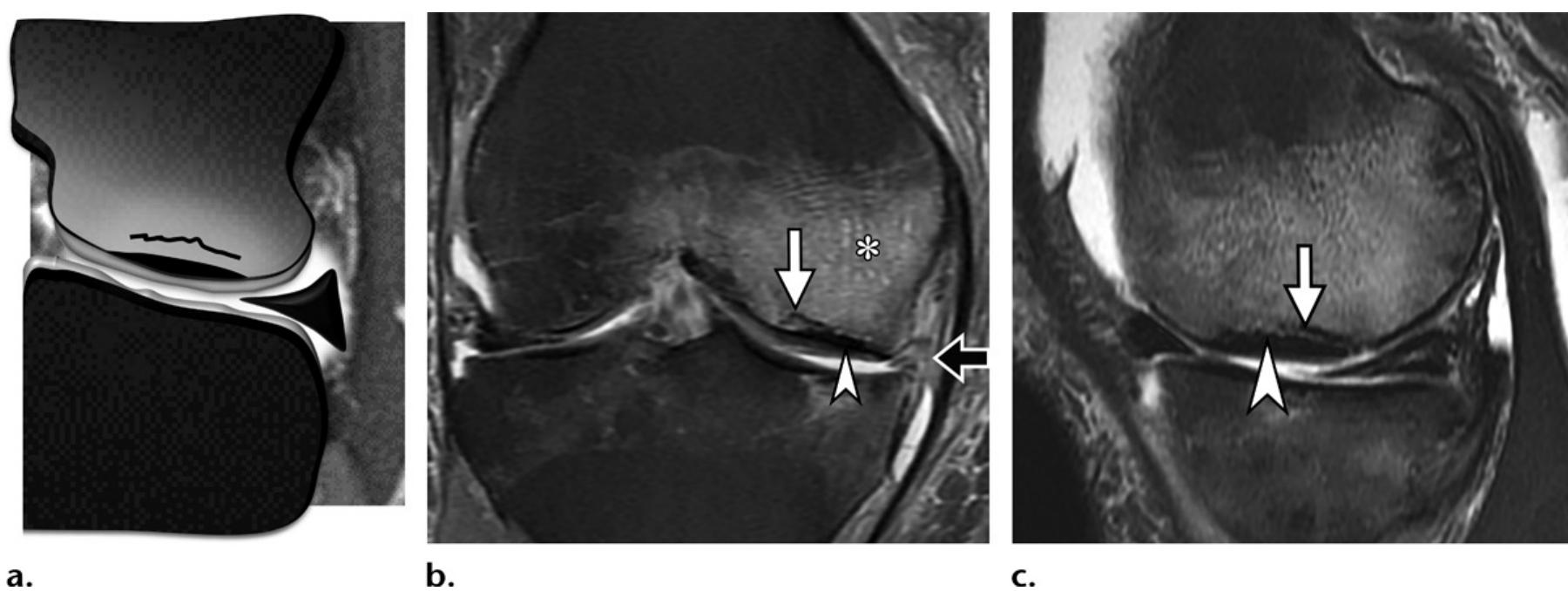 Figure 7 - from Osteochondral Lesions of the Knee: