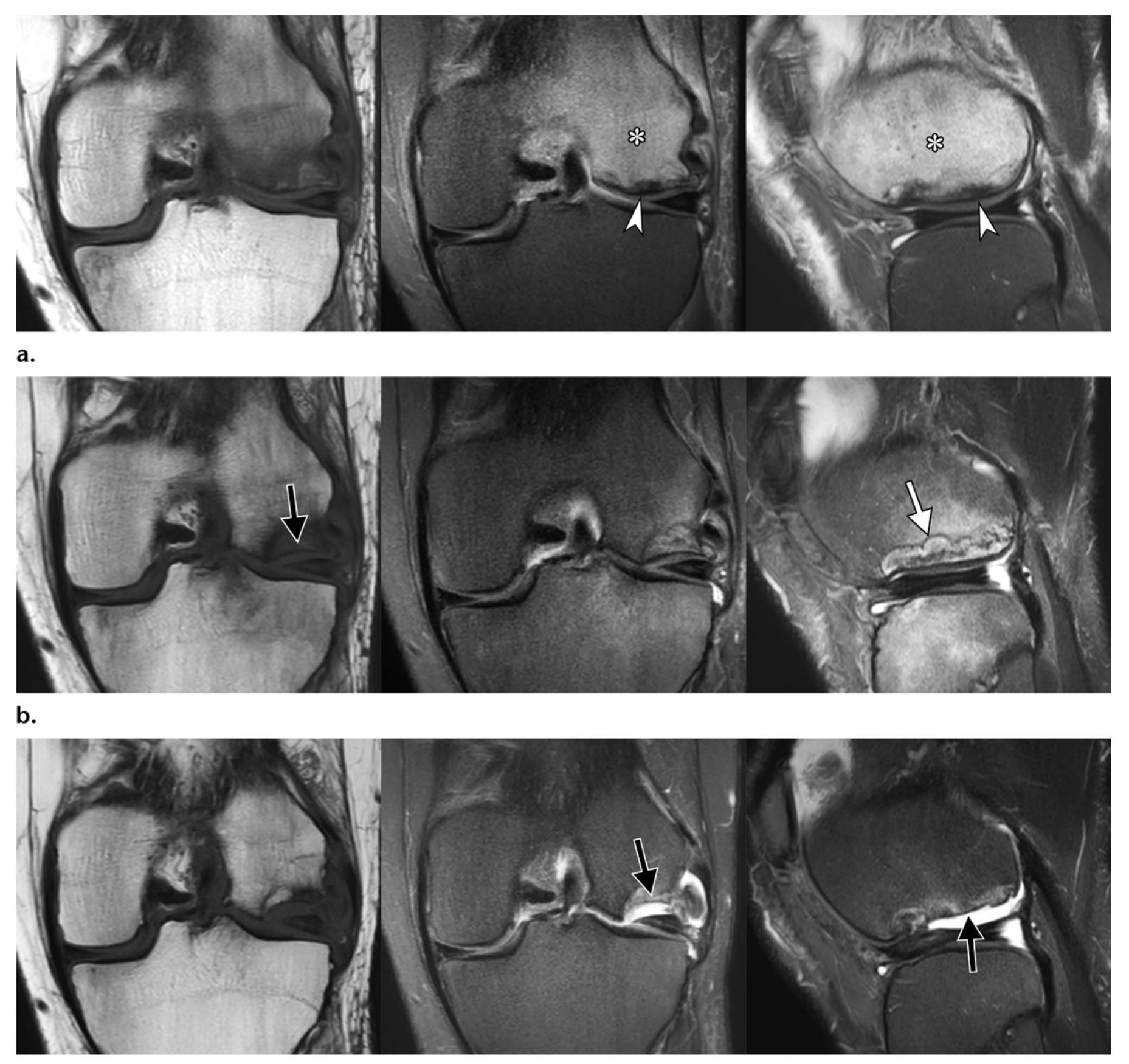Irreversible sif of the lateral femoral condyle progressing