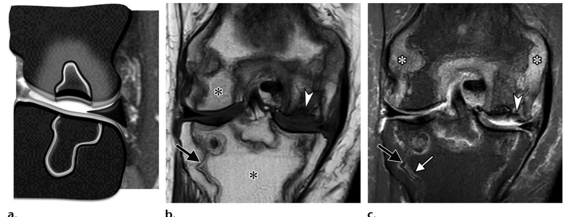 Avn of the knee in a 59-year-old woman who was undergoing