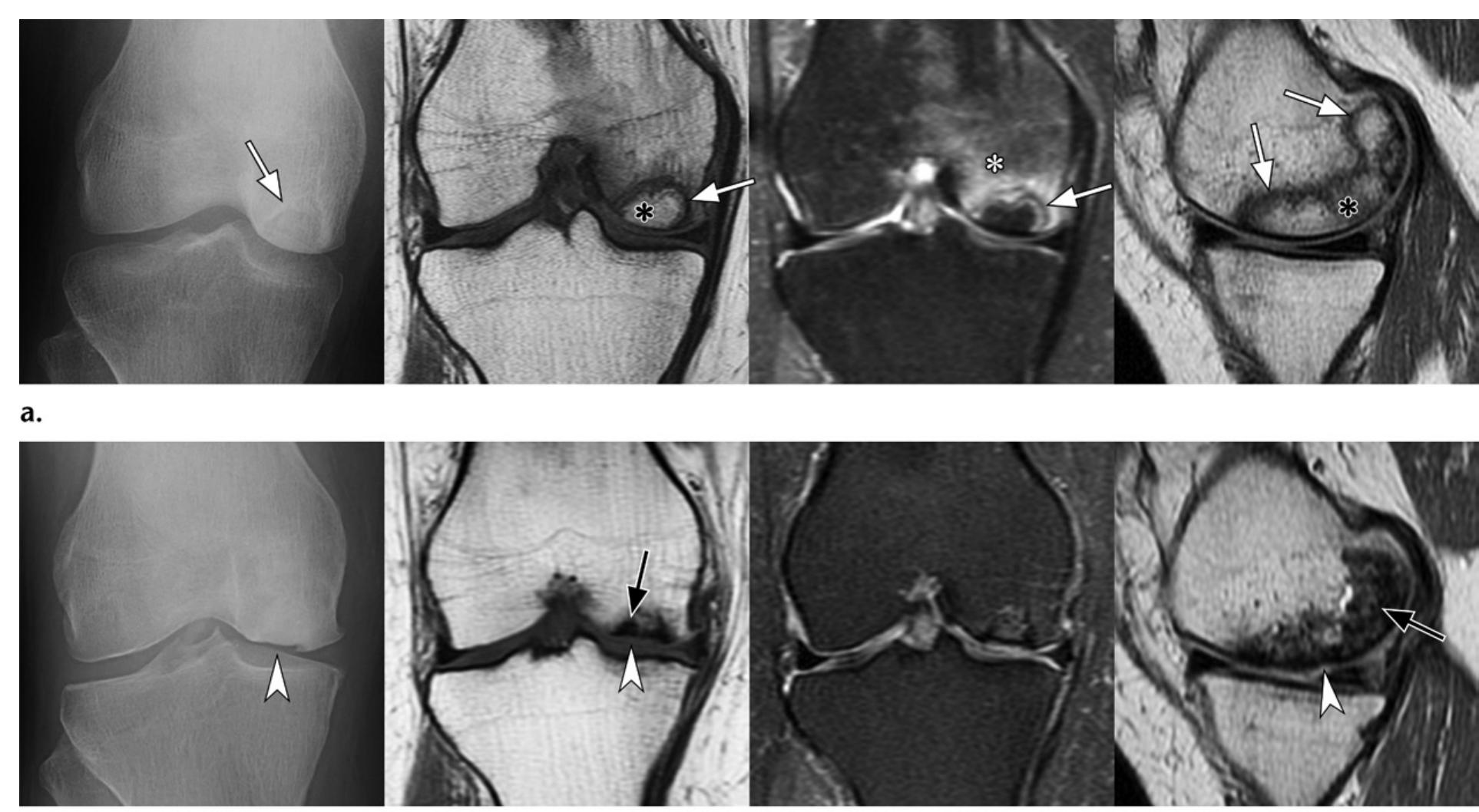 Avn of the medial femoral condyle in a 29-year-old woman