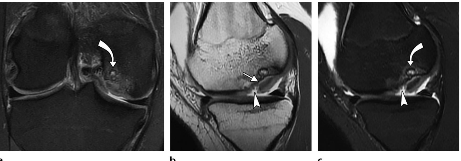 Unstable ocd lesion in a 17-year-old boy. coronal