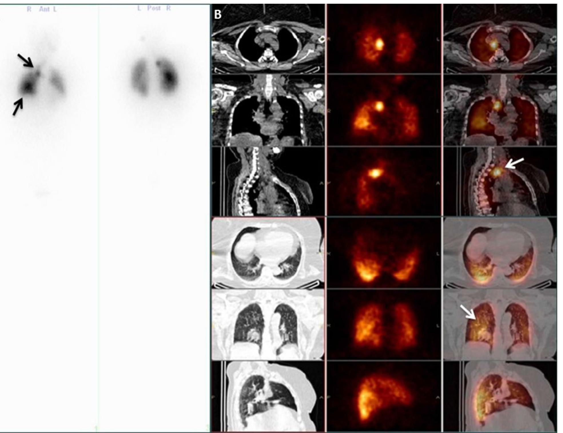 Figure 1 - from The impact of post-radioiodine therapy