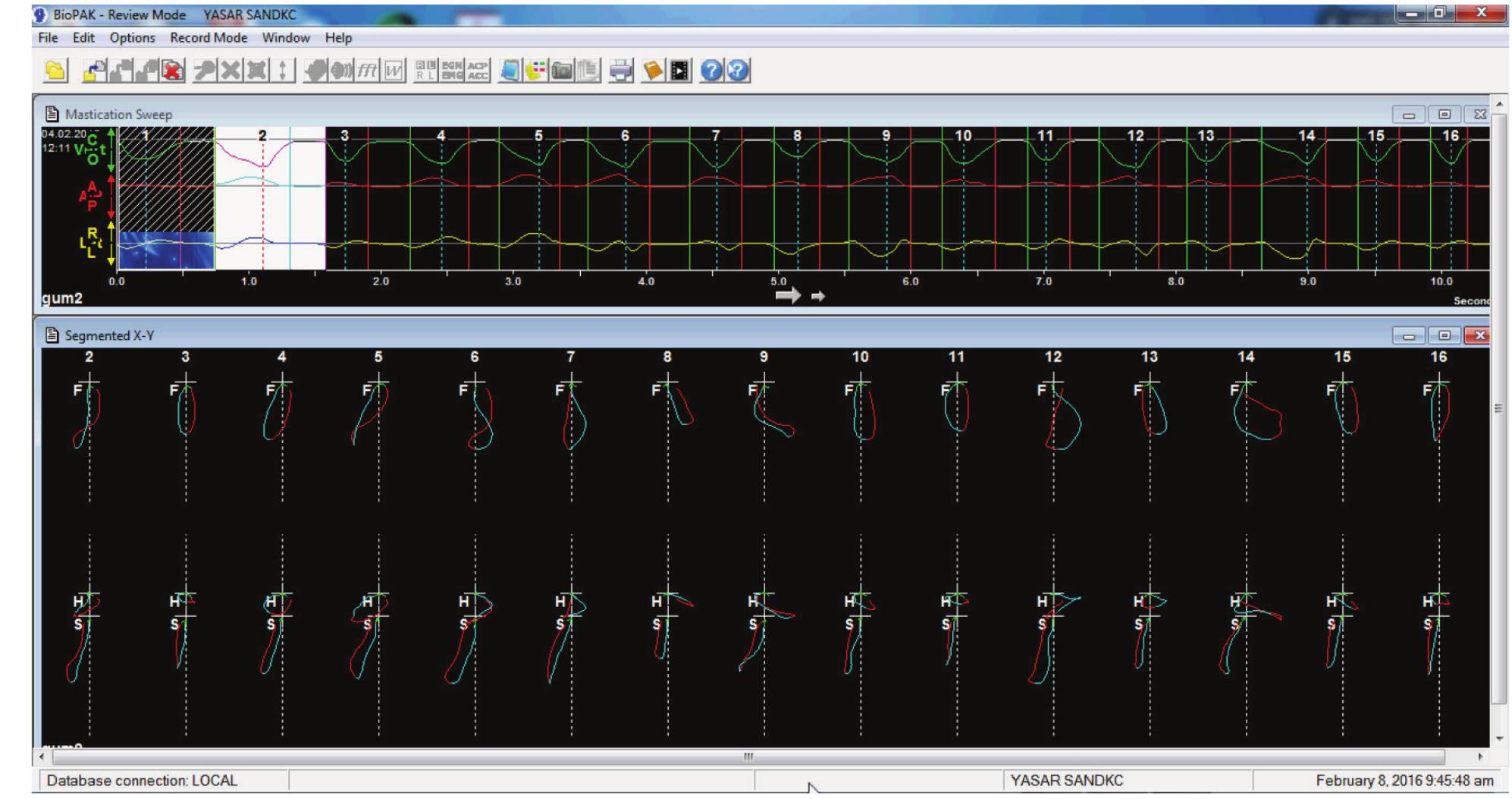 Irregular masticatory pattern of a patient with new denture