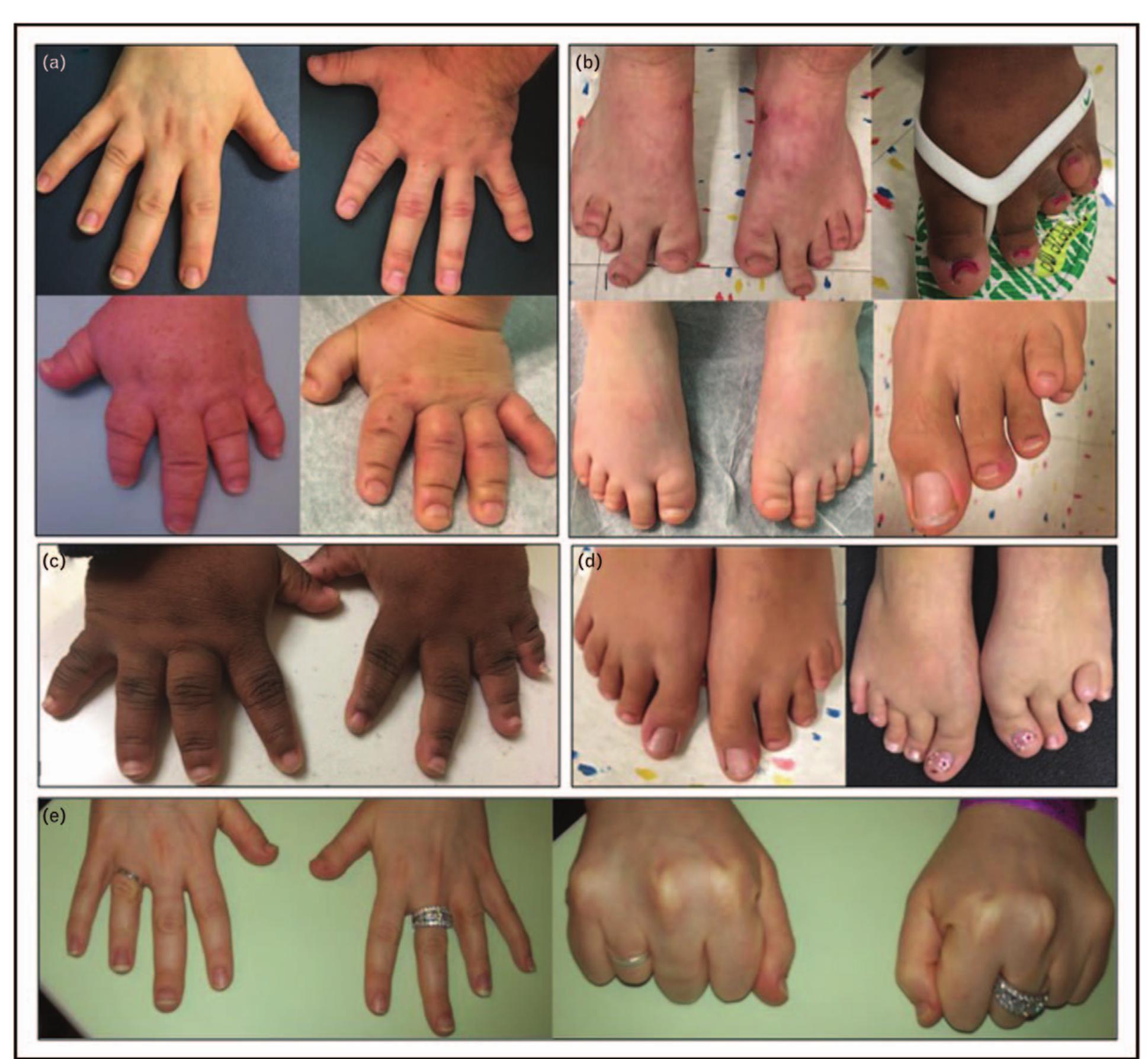 Brachydactyly can be varied and asymmetric in aho. (a) hands