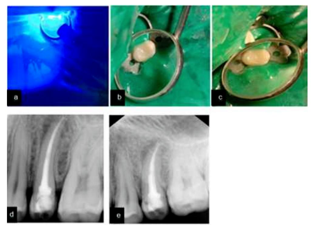 Light curing of the bonding agent; a: resection of the