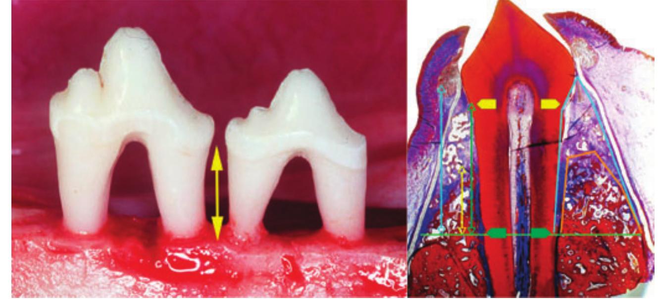 The critical-size, supraalveolar periodontal defect model.