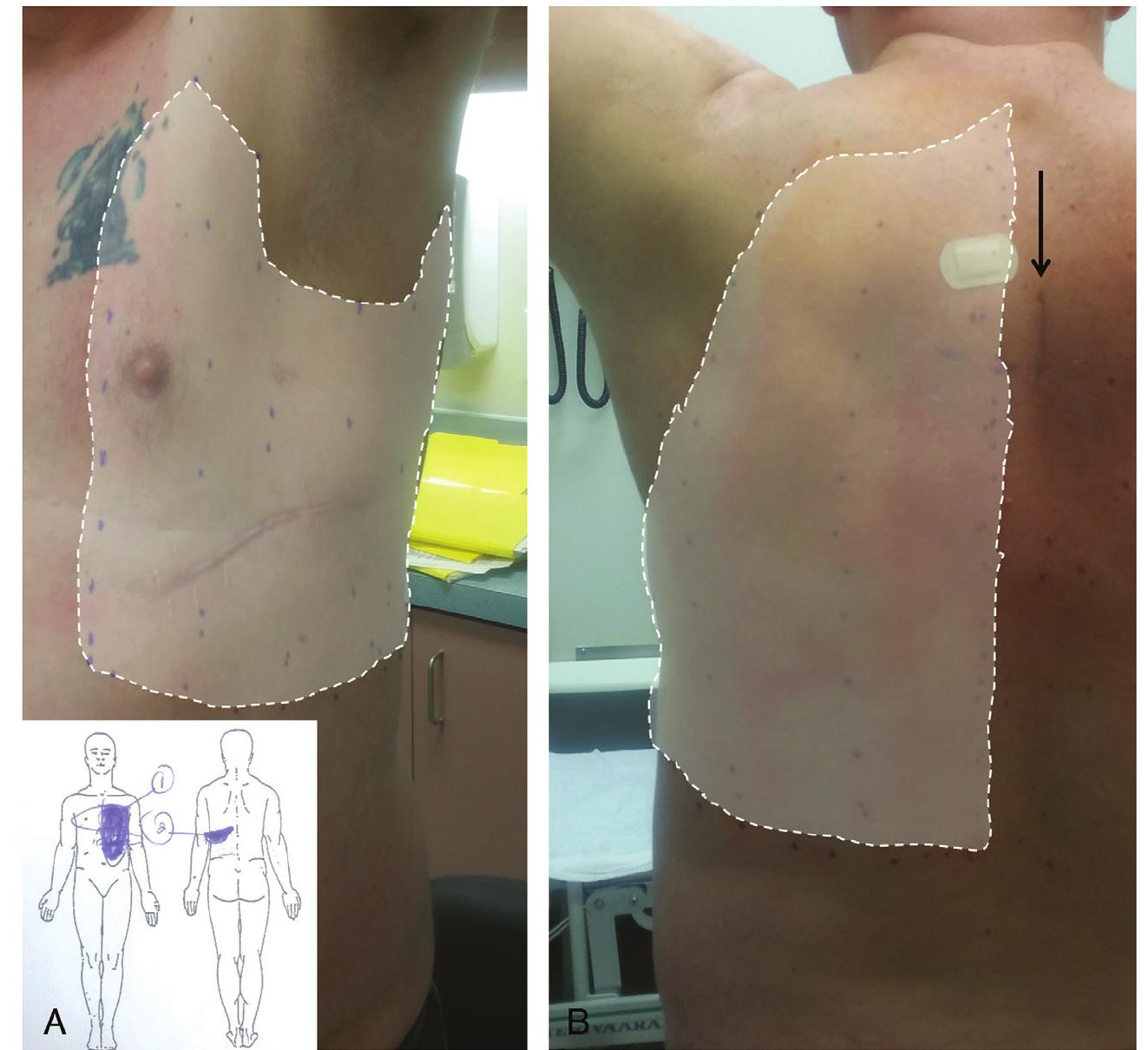 Extent of cutaneous sensory loss over the anterior (a) and