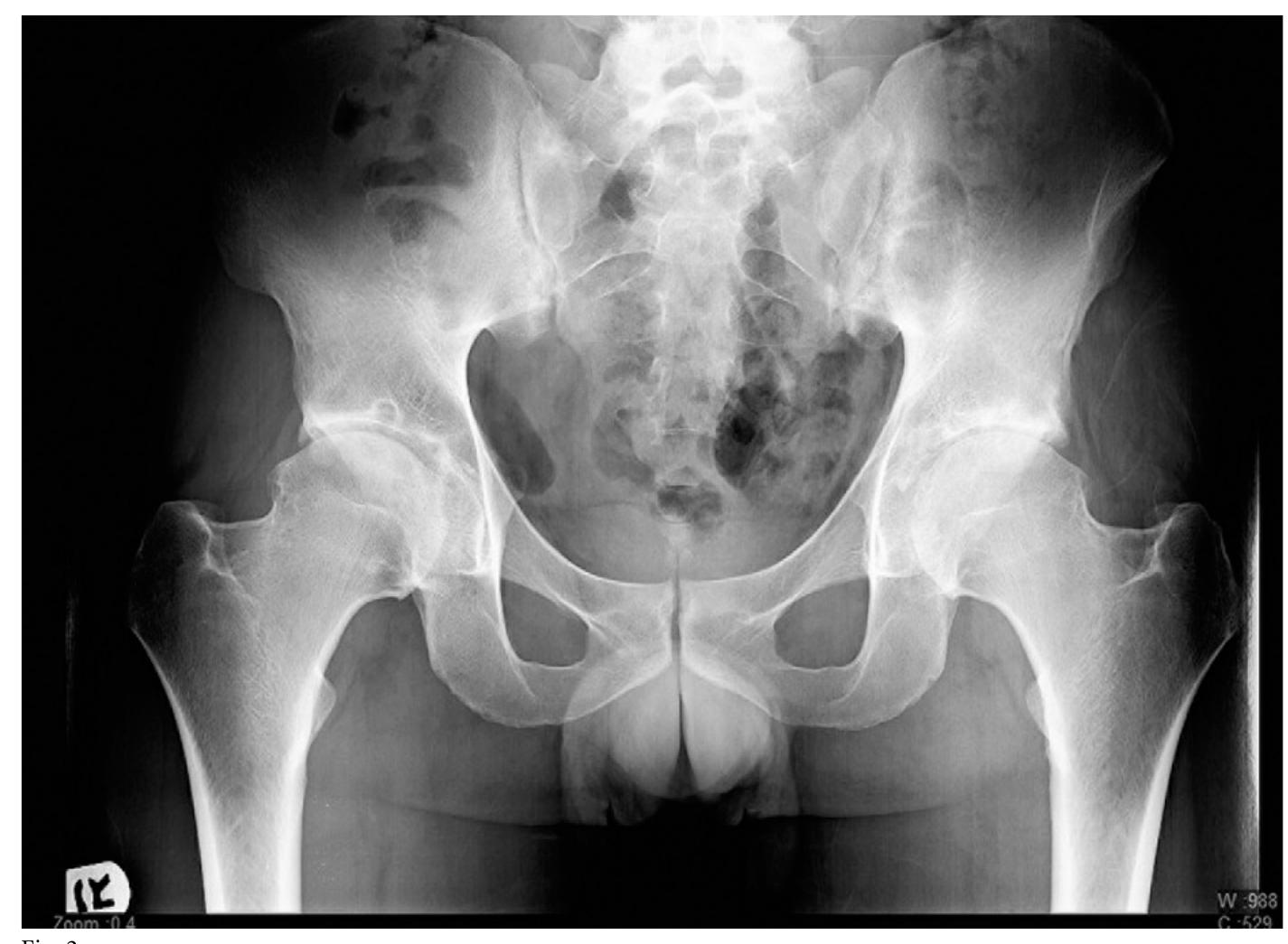 Pelvic radiograph showing bilateral signs of coxarthrosis.