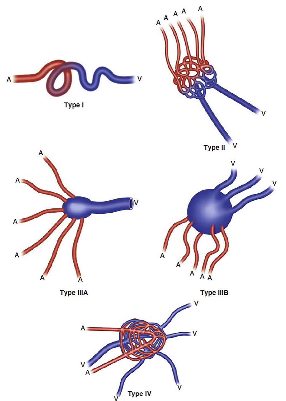 Yakes classification of avm angioarchitecture (2). type