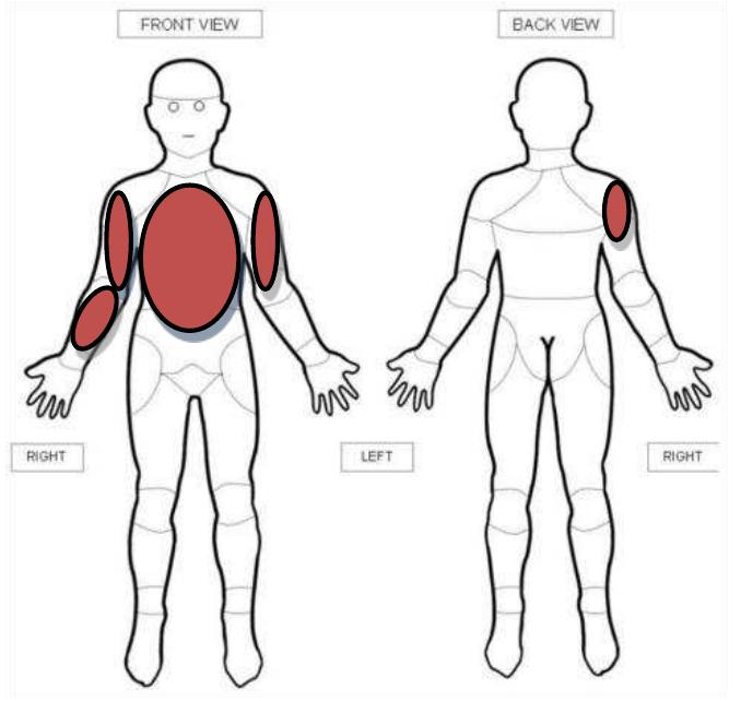 Burn diagram represents the site of burn in patient