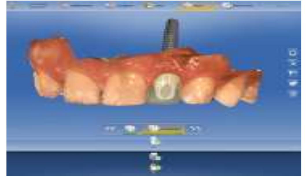 Ideal implant positioning fig. 3. cerec guide, dentsply