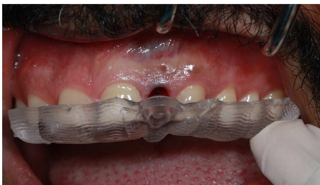 The static guide technique is commonly used for minimal