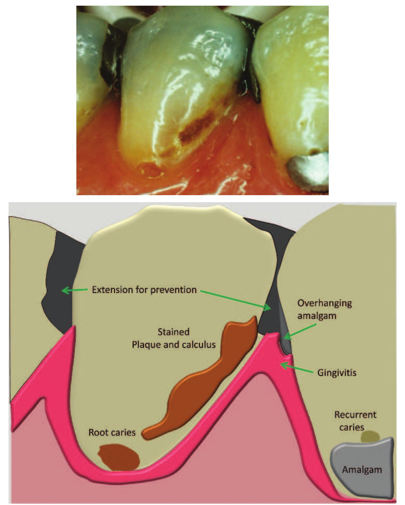-19 example of root caries. this clinical image of a