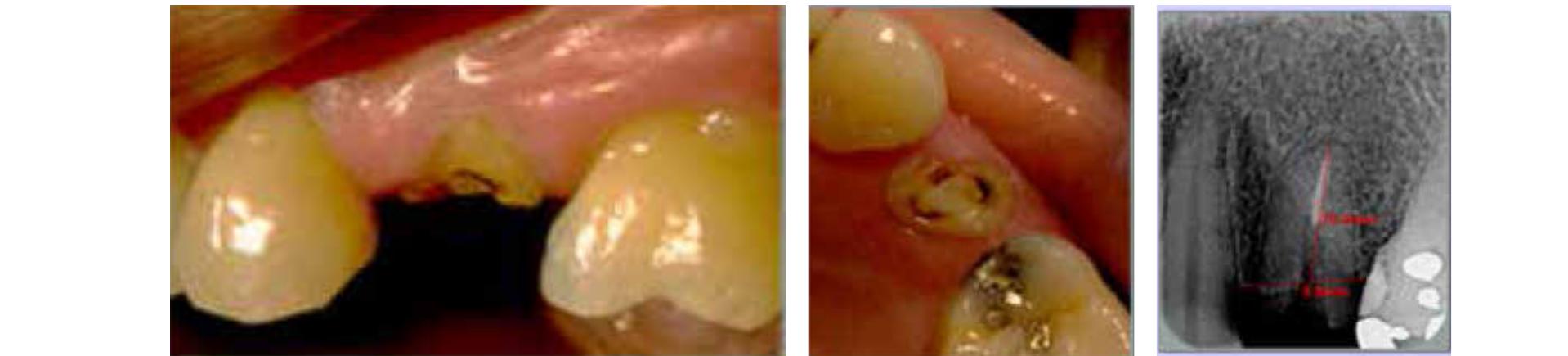 Foto clinica y radiografia prequirurgica 24 resto radicular