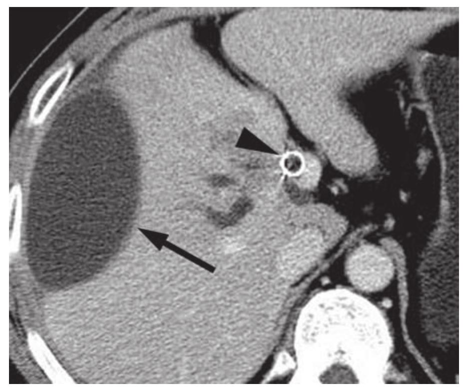 Subcapsular biloma in a 54-year-old man with bile duct