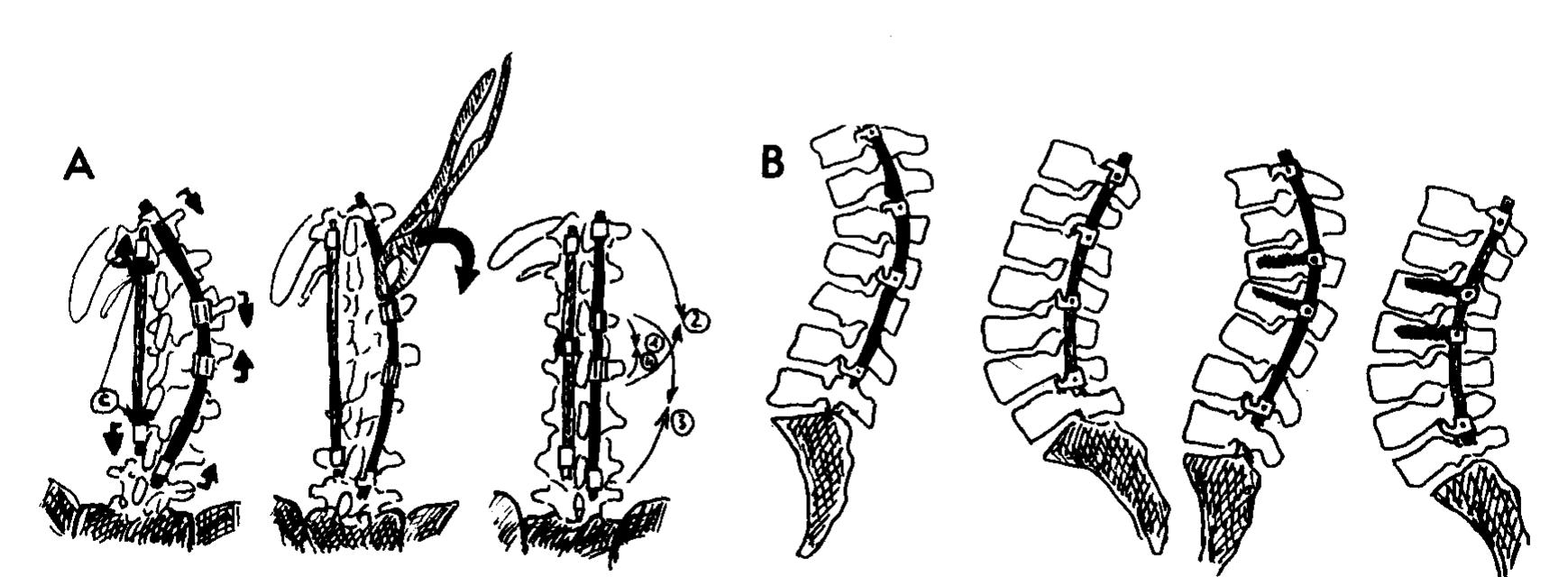 Fics. 3a and 3b. drawing of thoracolumbar and lumbar