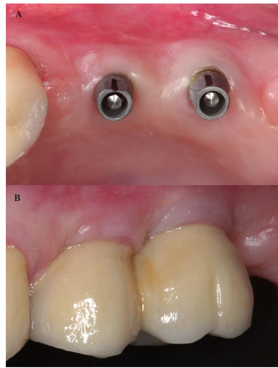 A) occlusal image of keratinized mucosa around implants with