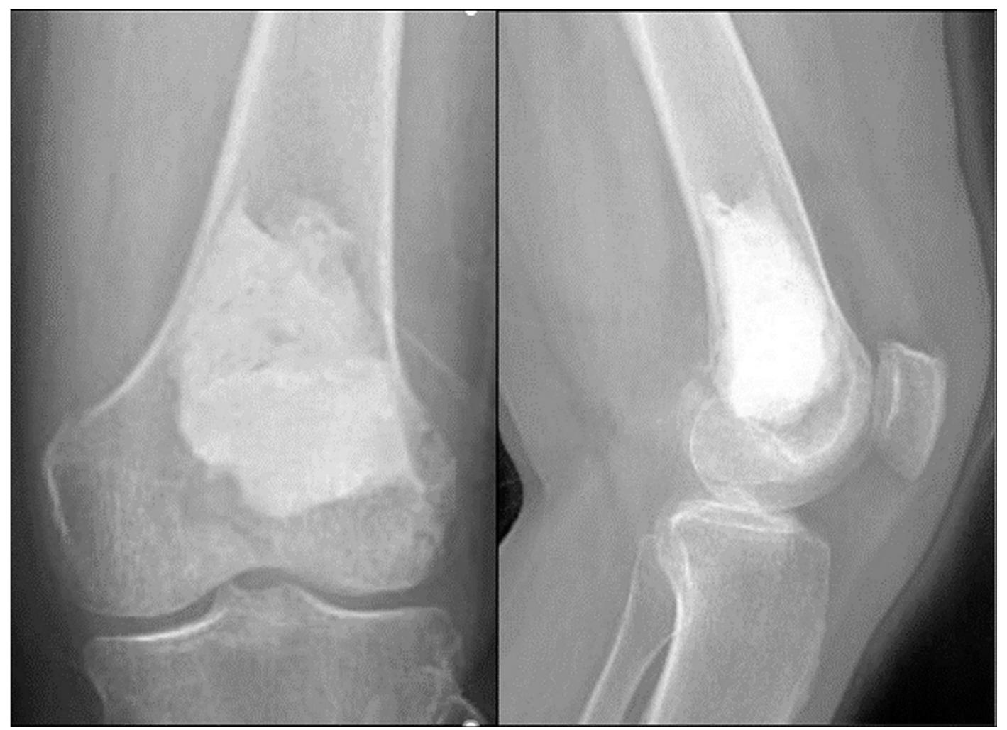 Anterior-posterior (ap) and lateral radiographs of the left