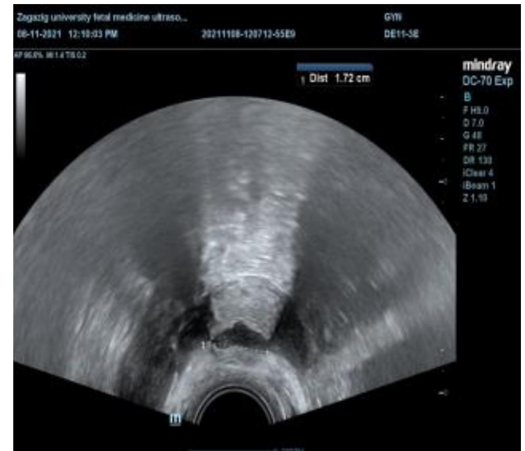 (d) showing ultrasound transverse view of cesarean scar