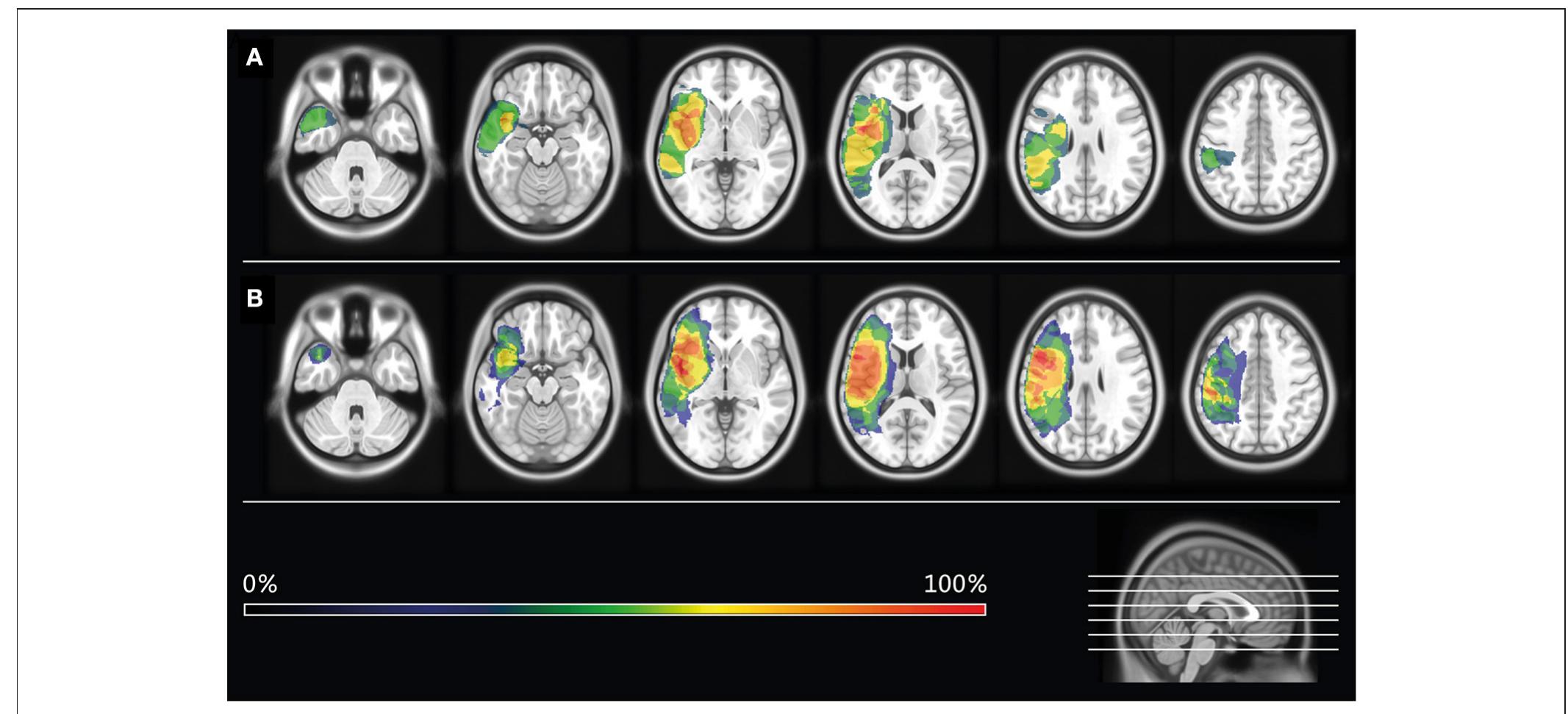 | lesion overlay maps. lesion overlay maps of patients