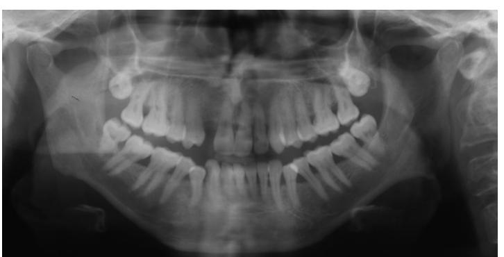 Panoramic radiograph showing bony rarefaction and deformity