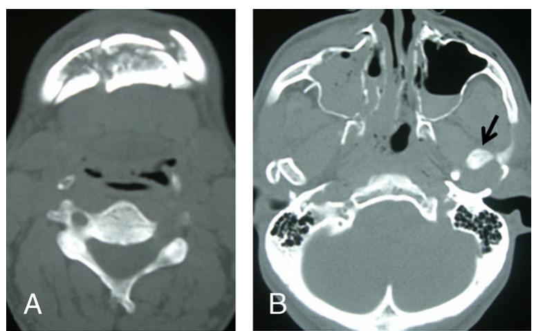 A and b, face ct scan showing a left tmj dislocation