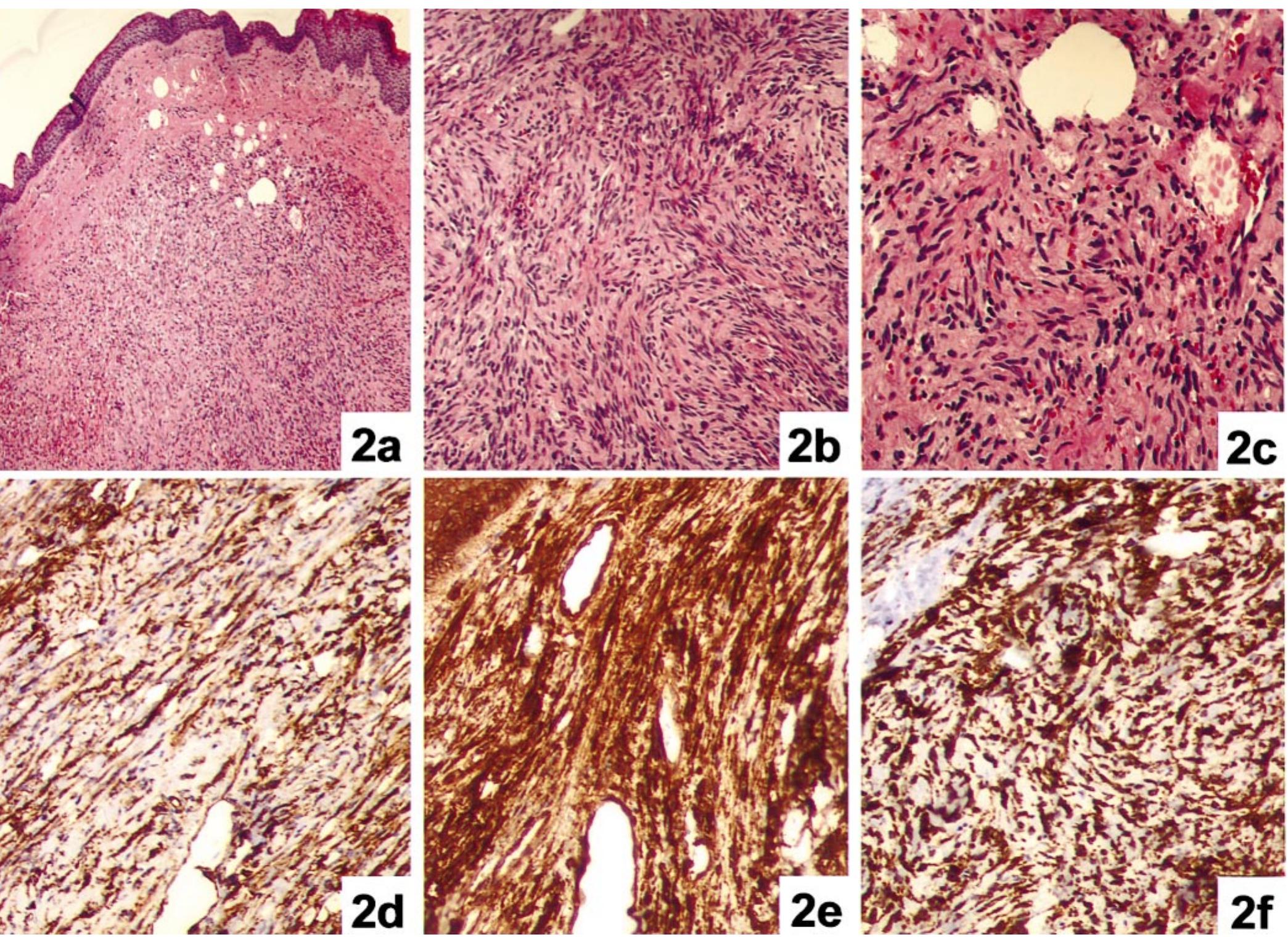 Histologic section that shows a polypoid spindle cell lesion
