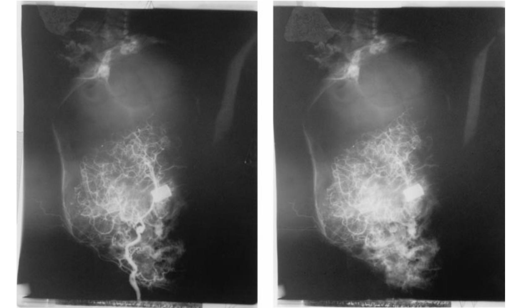 2 | carotid angiogram in the small twin. arterial and venous