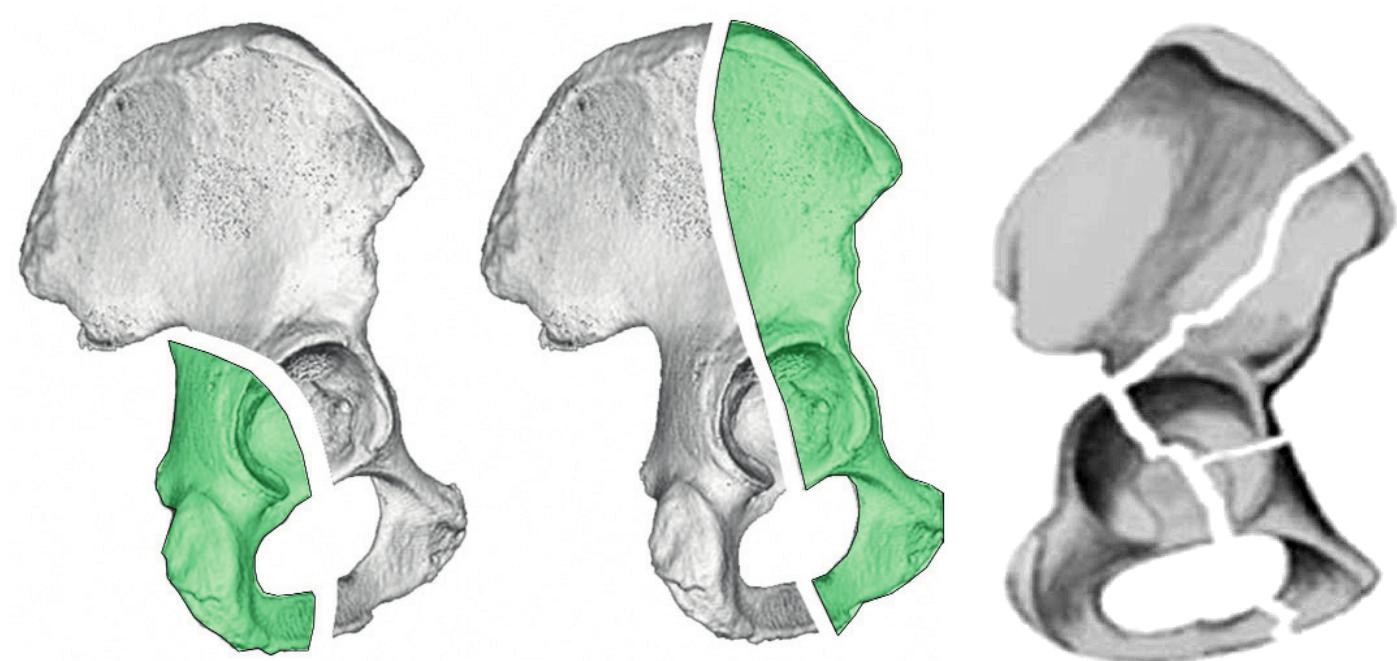 Schematic view of a typical both-column fracture with a