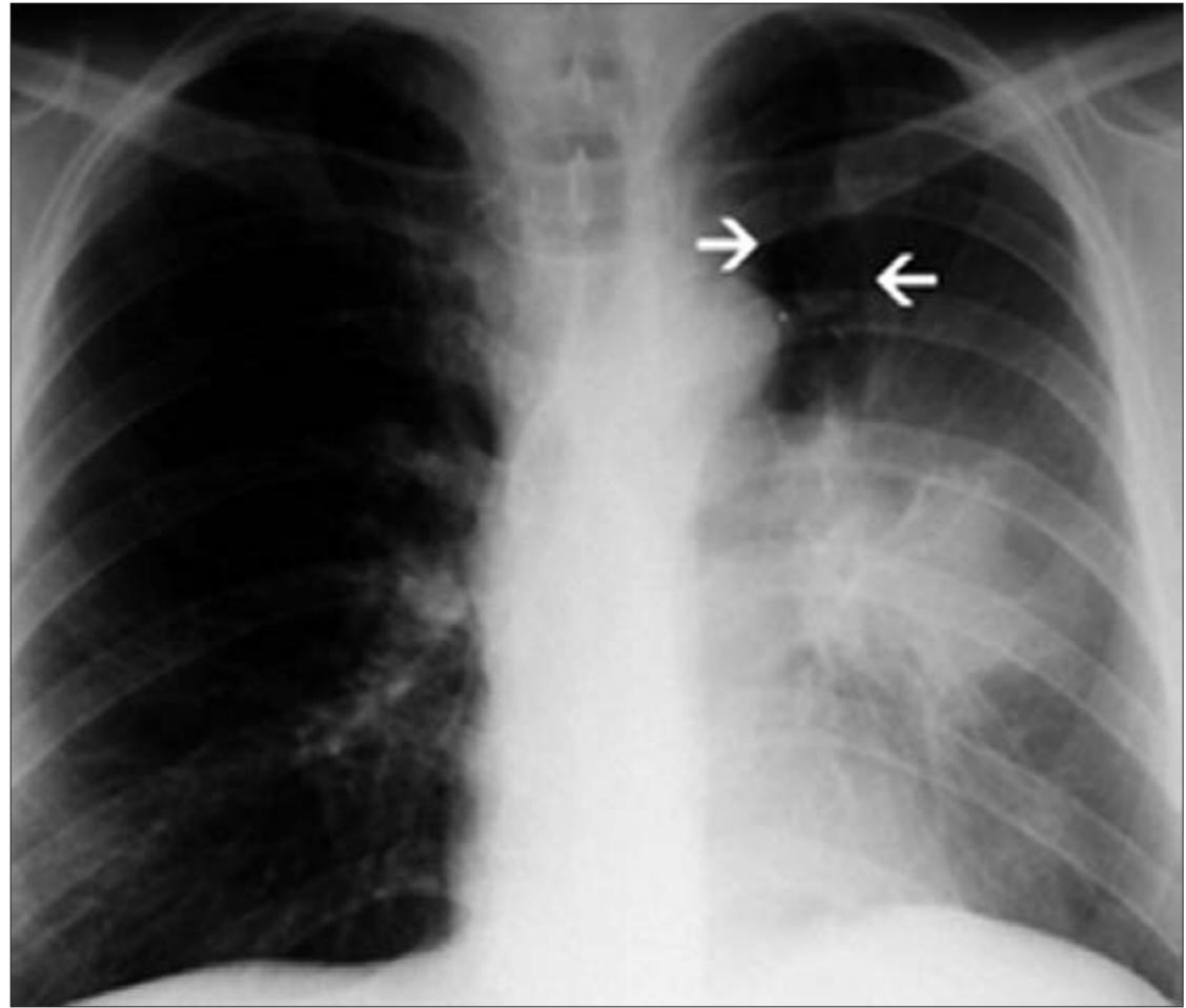 Figure 10 - Signs in chest imaging: a pictorial review