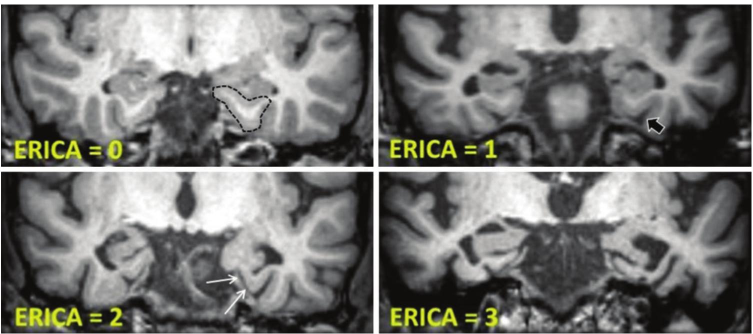 The erica score. the visual pattern for entorhinal cortex