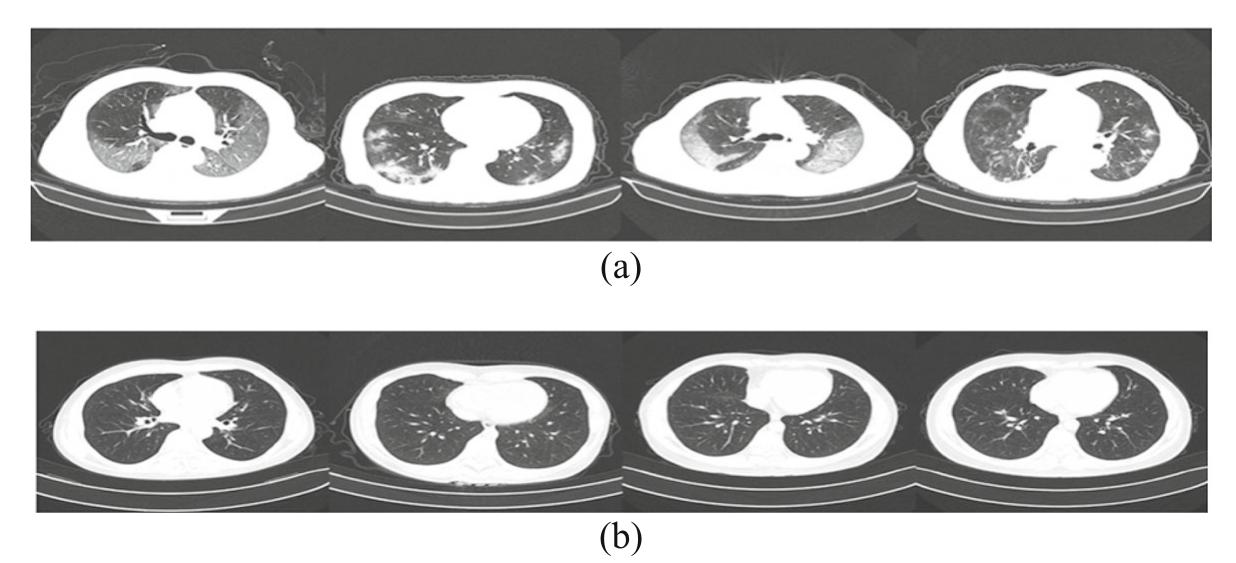 Example chest ct images from the covidx-ct dataset, (a)