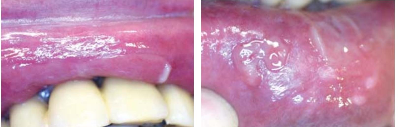 The mandibular labial mucosa shows serpiginous ulcerations