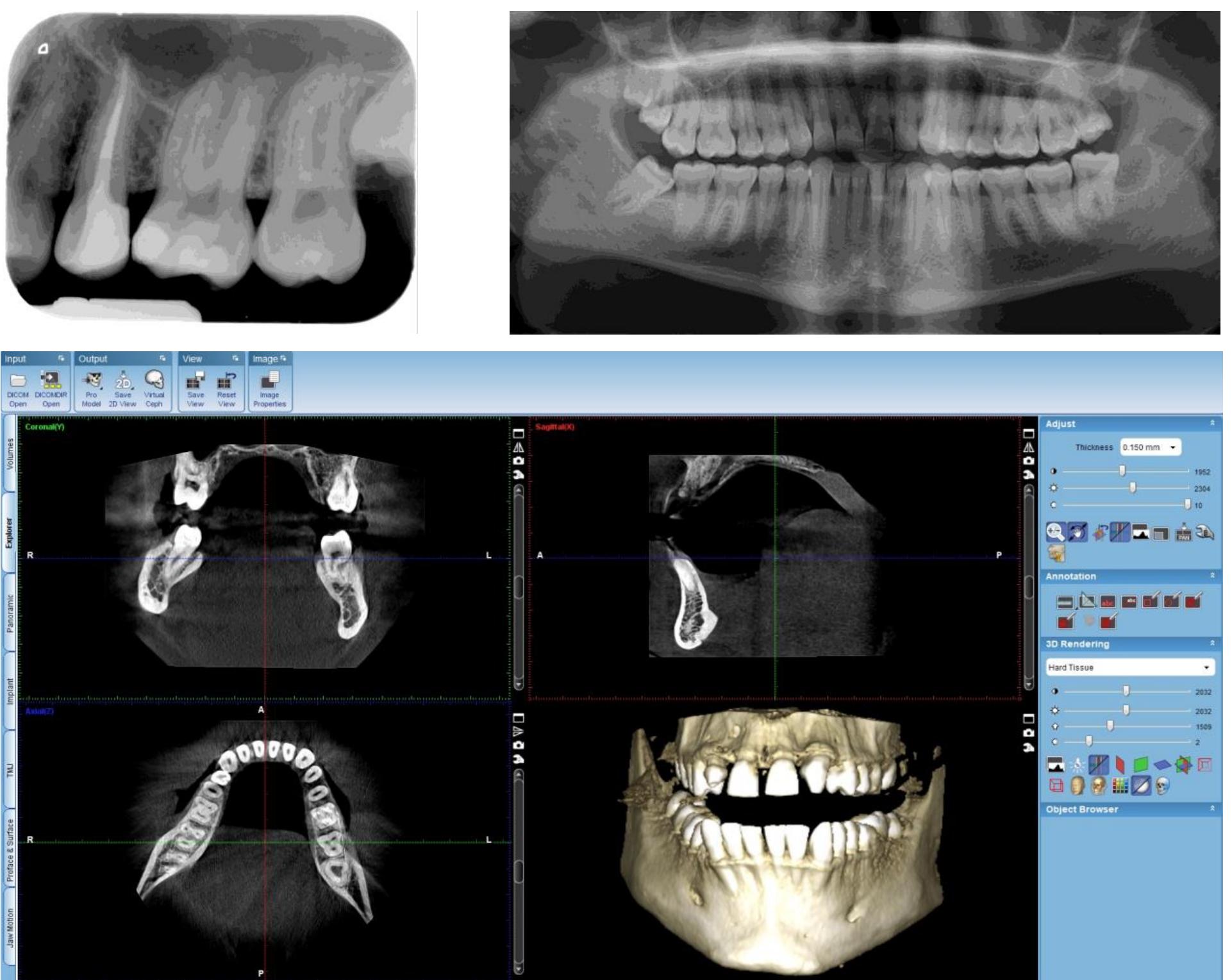 Examples of intraoral radiographs, panoramic radiographs, as