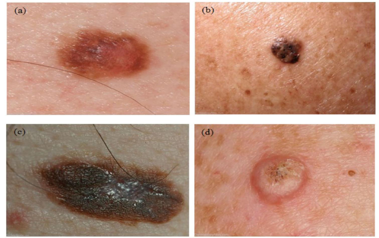 Skin lesions examples: (a) dysplastic nevus, (b) seborrheic