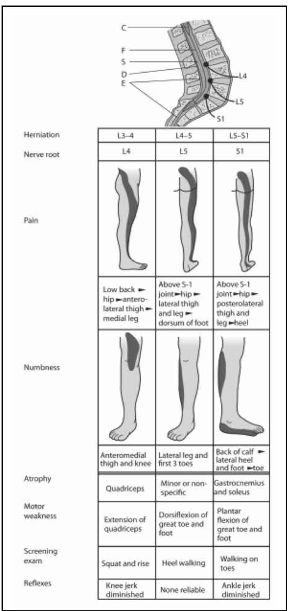 Clinical features of a posterolateral lumbar intervertebral