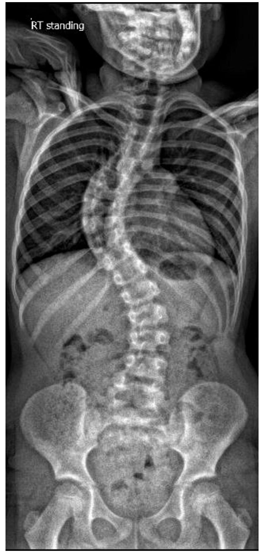 Posteroanterior radiograph of the spine showing thoracic