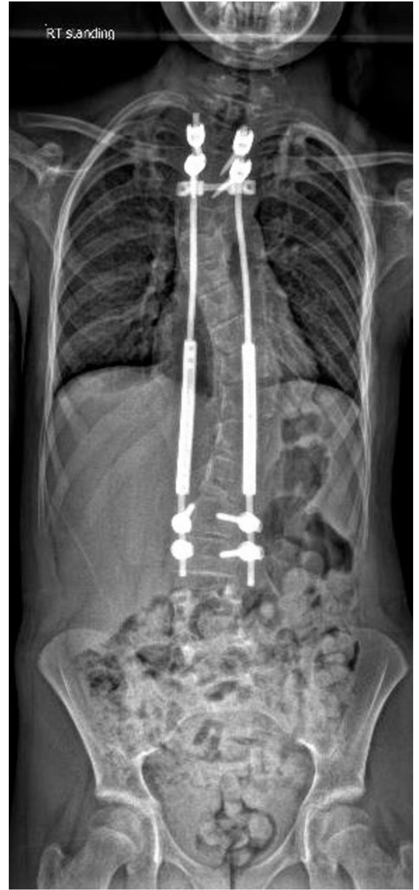 Radiograph showing a dual traditional growing rods construct