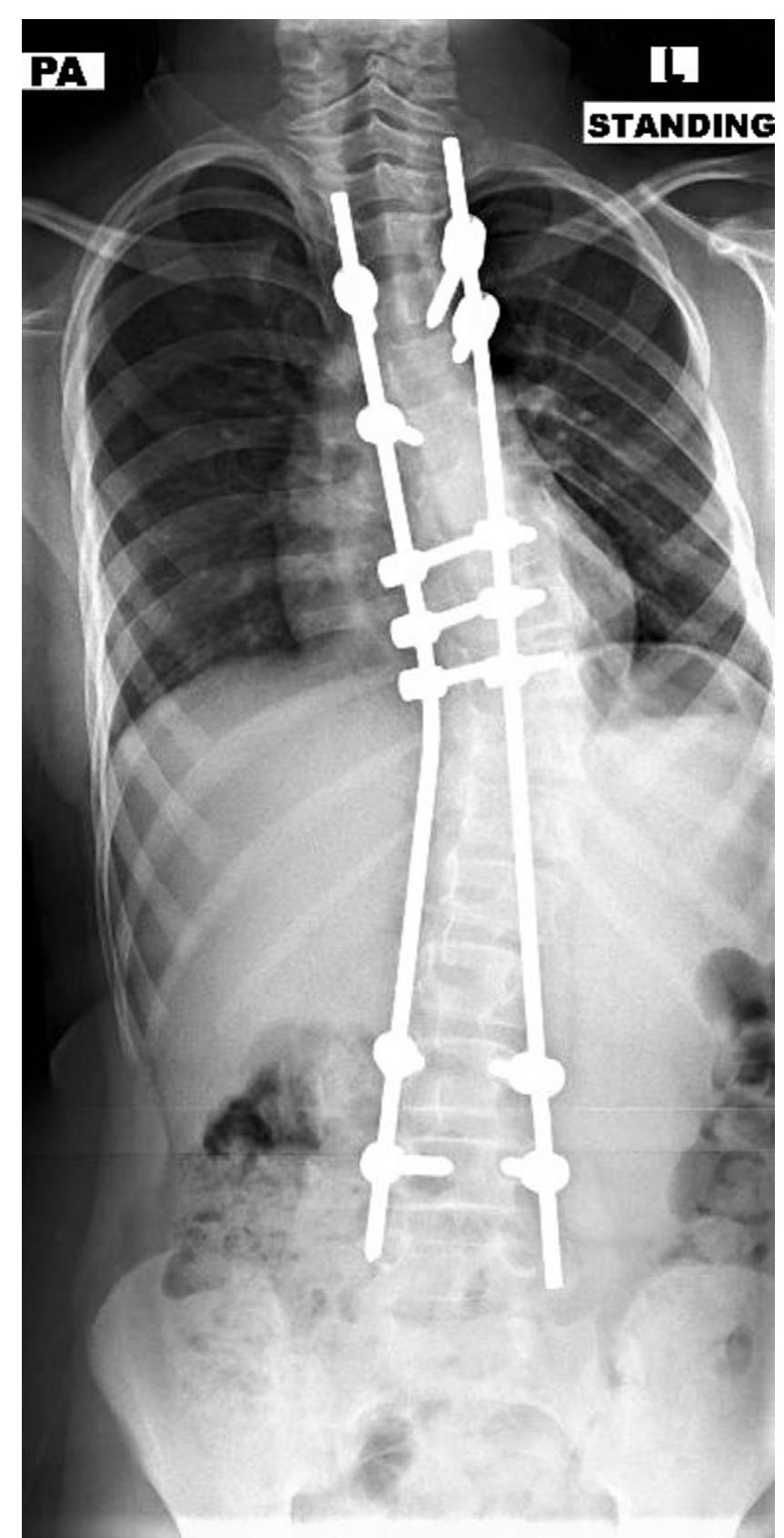 Radiograph of shilla growth guidance system.