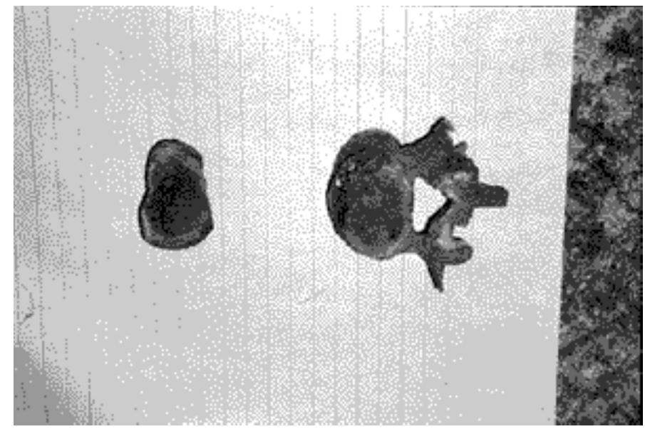 Upper extremities: the left humerus and left ulna are
