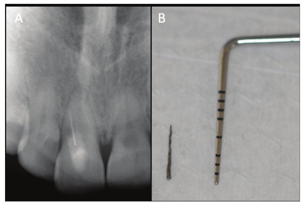 A) periapical radiograph of maxillary right incisor tooth;