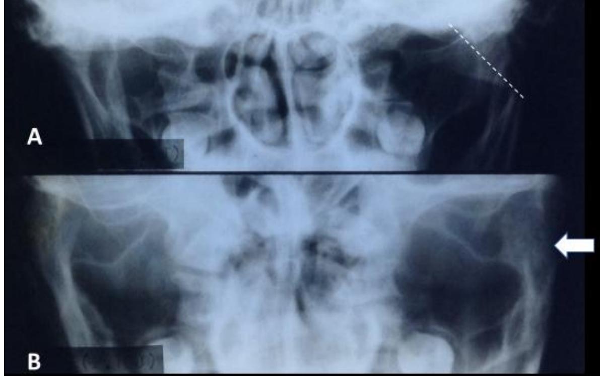 A: angle of deviation-dislocation fracture is 60 degrees