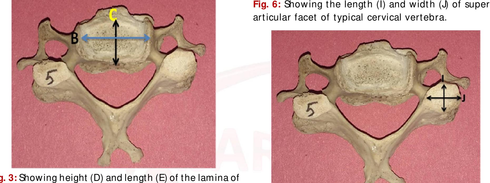 Showing the transverse diameter (b) and antero- posterior