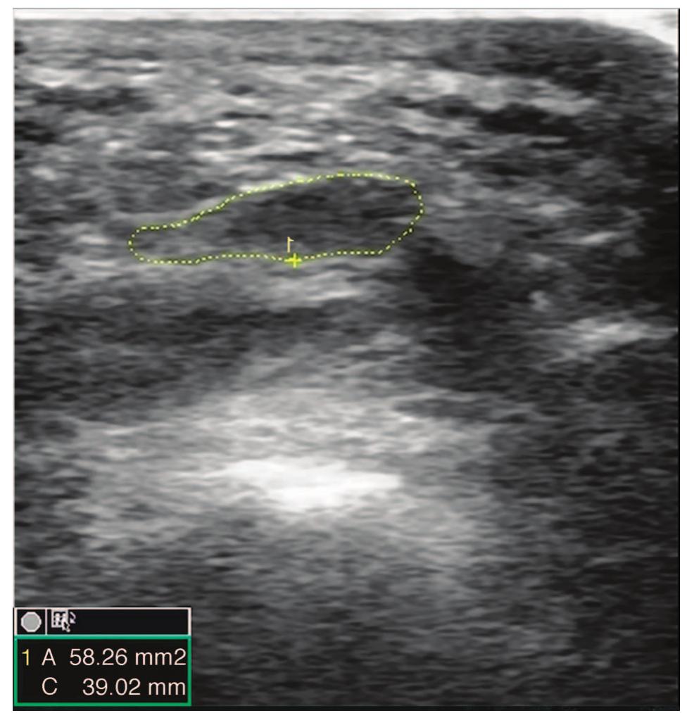 The axial ultrasound image shows the cross-sectional area of