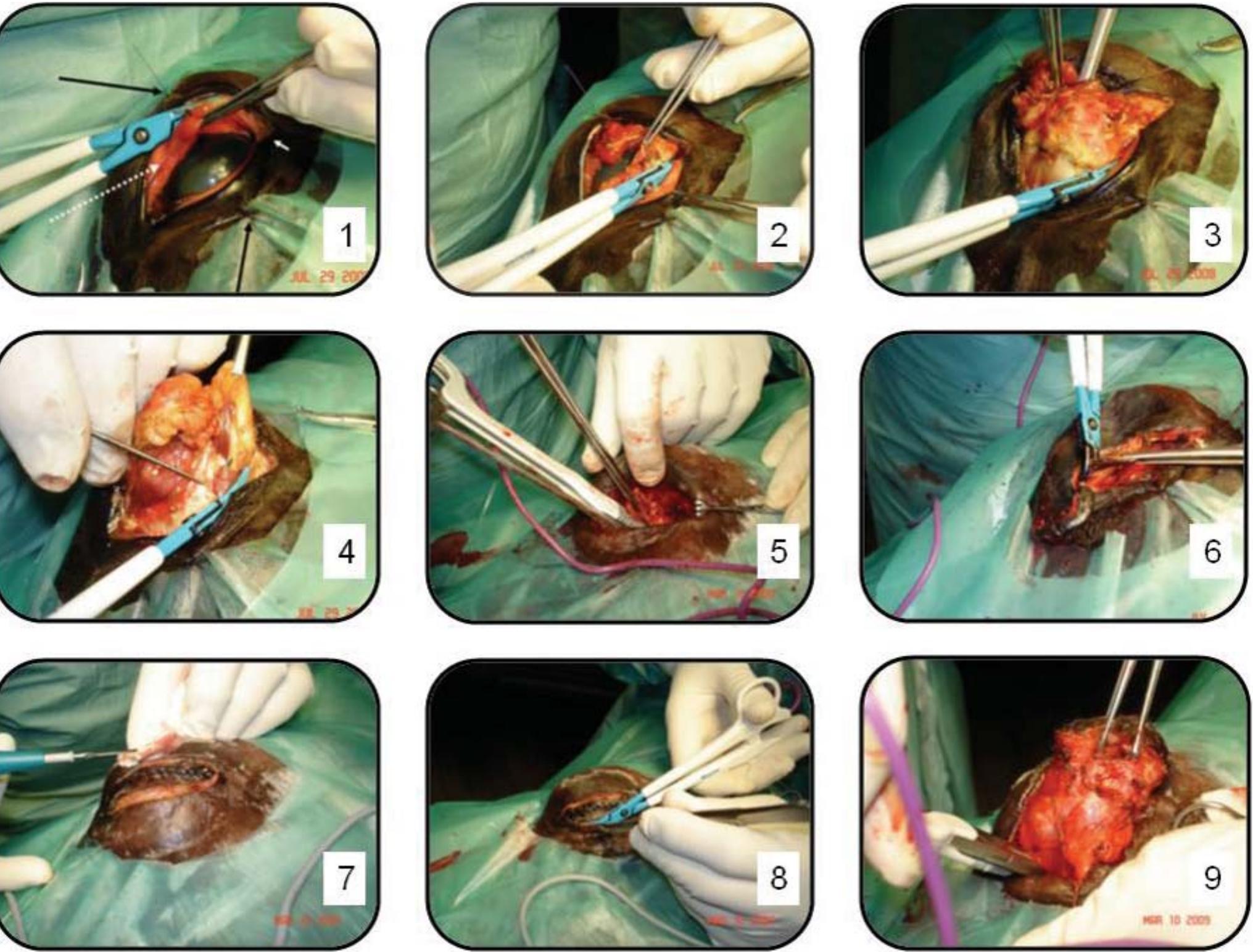 The different steps of the procedure using the ligasure or